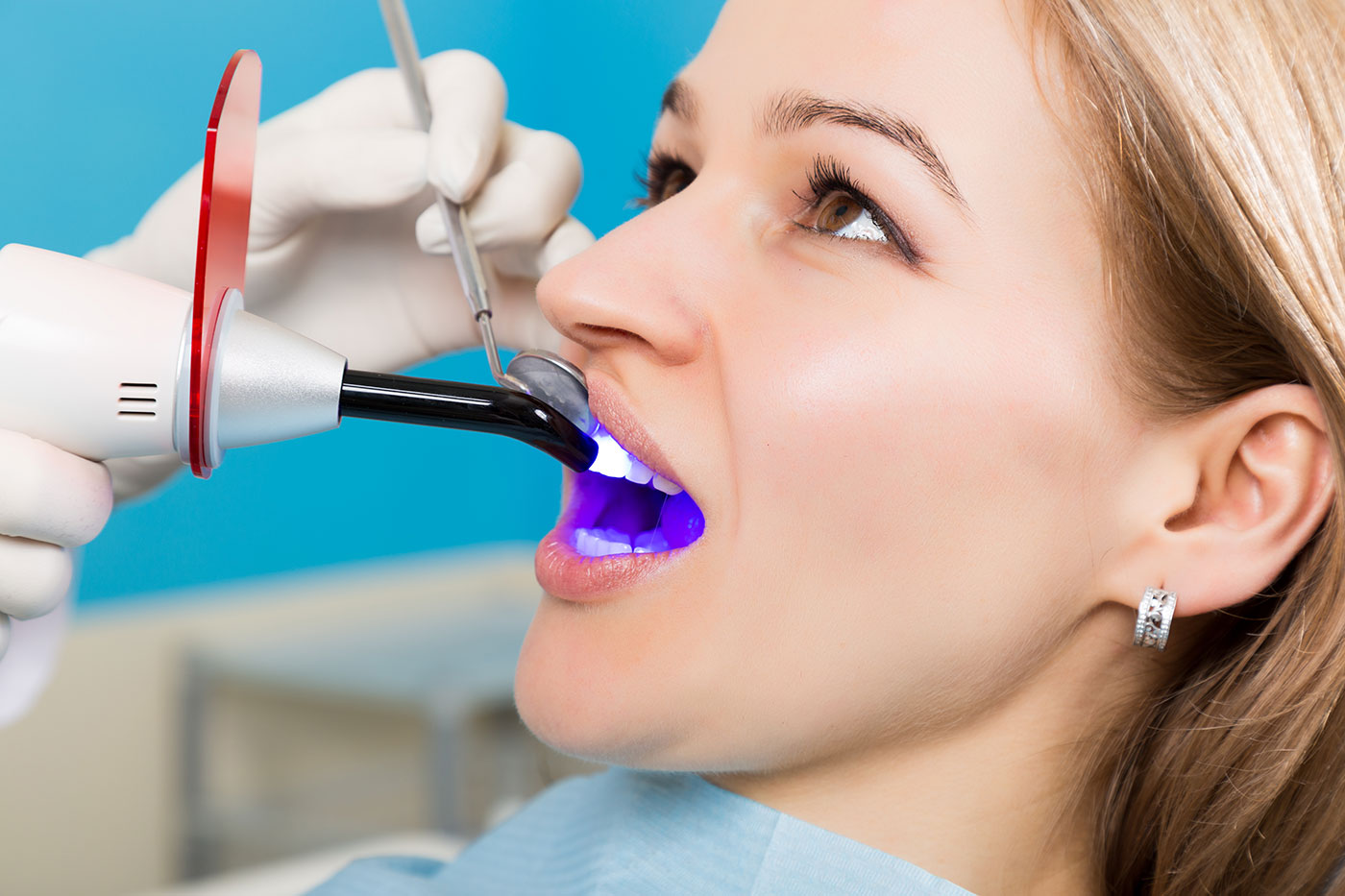 Composite Bonding - Ilfracombe